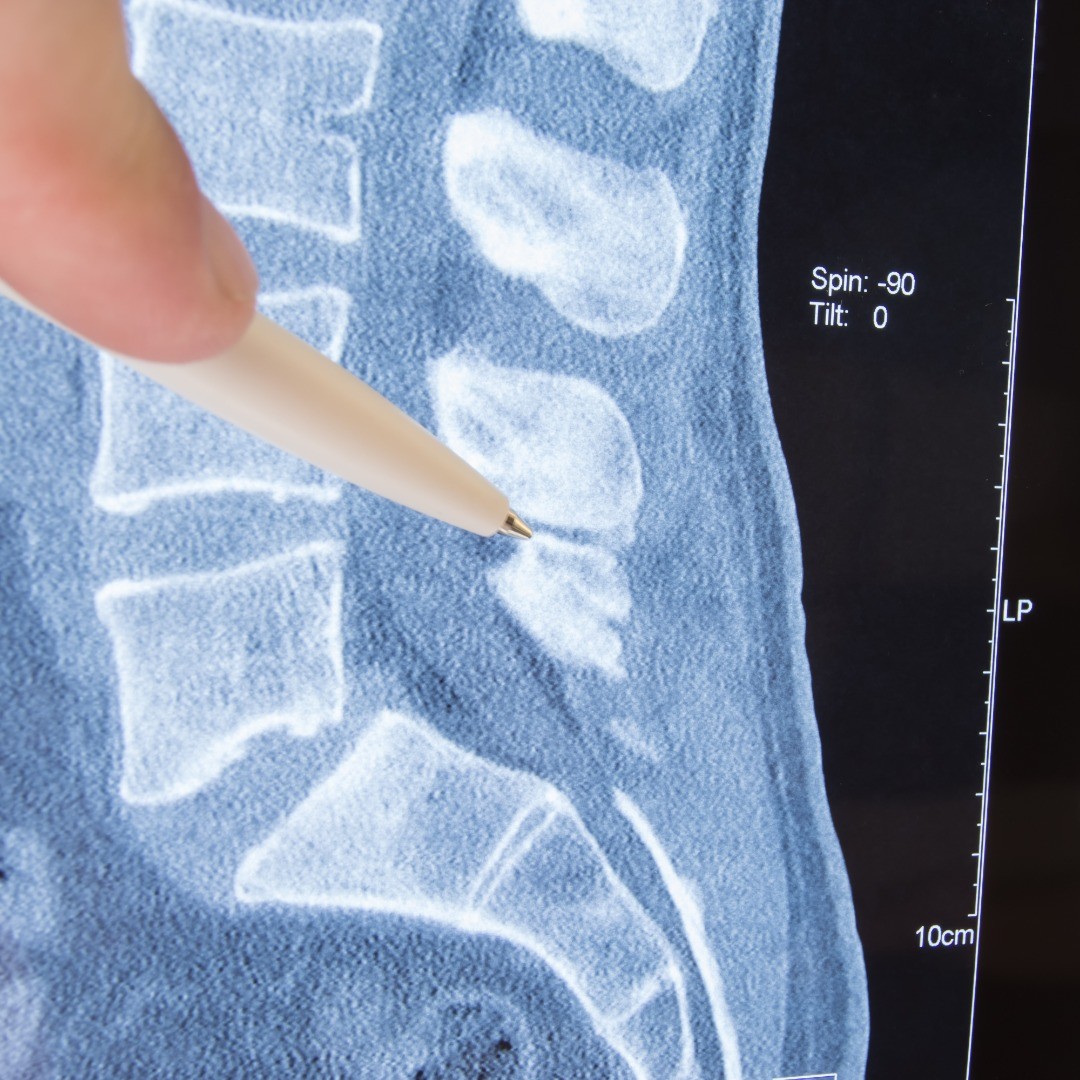 Lumbar Fusion | Spine Fusion Surgery Long Island | NSPC